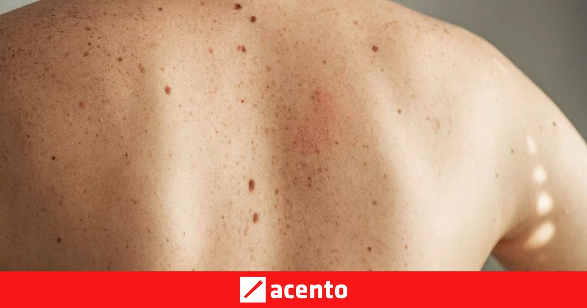 Melanoma: tipo más grave de cáncer de piel | Acento